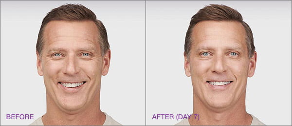 BOTOX for Men | Berks Plastic Surgery