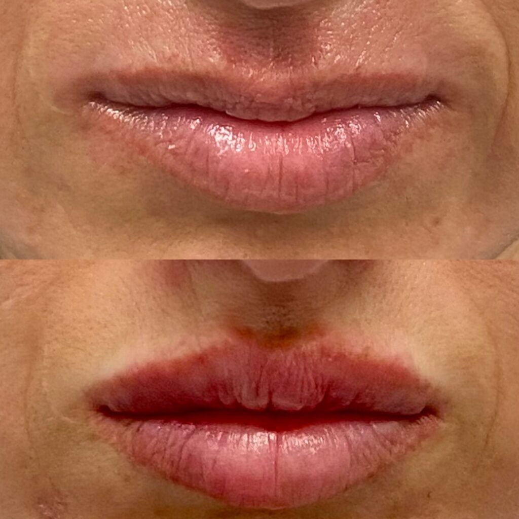 Lip Enhancement - Fillers & BOTOX in Reading - Berks Plastic Surgery