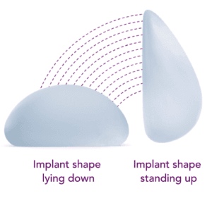 Dr. Reedy Answers Your Top Questions About Motiva Implants - Berks ...